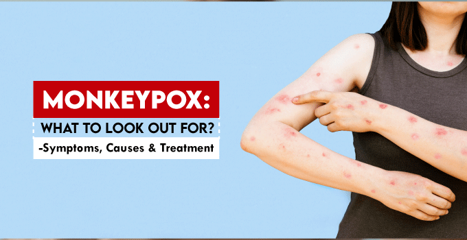 What is monkeypox? All you need to know about monkeypox